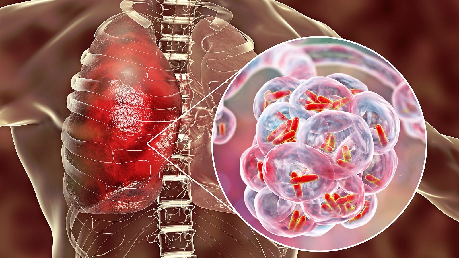 La tuberculosis repunta en España: aumenta un 7% en el último año ...